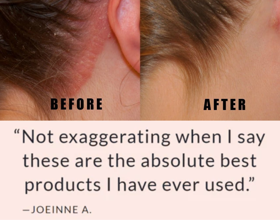 Scalp & Body Care For Your: Psoriasis, Eczema, Itching, Sores, Scabs